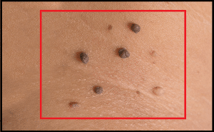 Acrocordones o fibromas Blandos: Causas, tratamientos y prevención ...